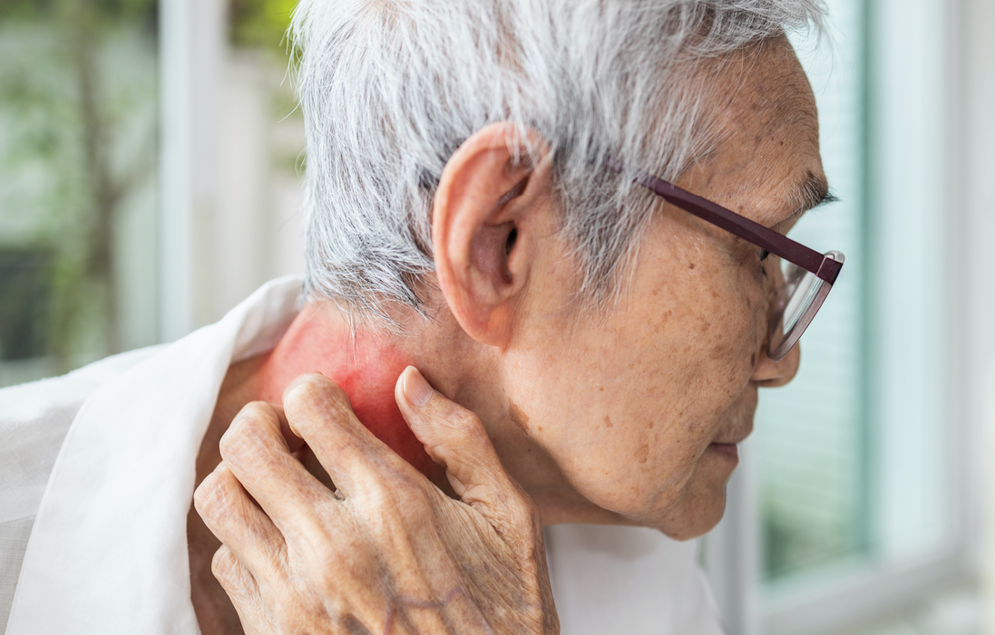 What Is Heat Rash? | Skin Wellness Physicians Blog